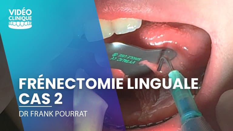 Frénectomie linguale cas n°2 - French Tooth